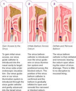 Balloon Sinuplasty Cary, NC - ENT Services Sanford, NC